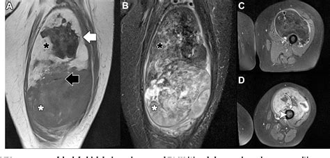 Liposarcoma Of The Thigh With Mixed Calcification And Ossification Semantic Scholar