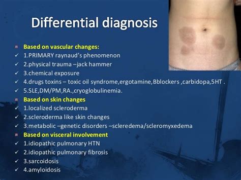 Systemic Sclerosis Scleroderma