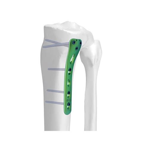 Proximal Tibia