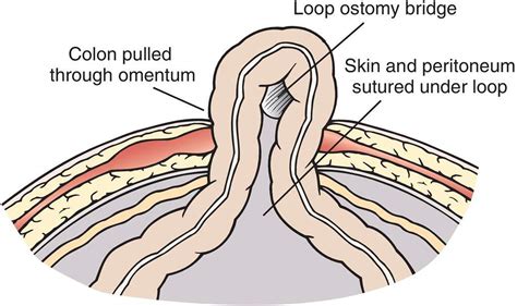 Colostomy How To Change A Colostomy Bag Living With It