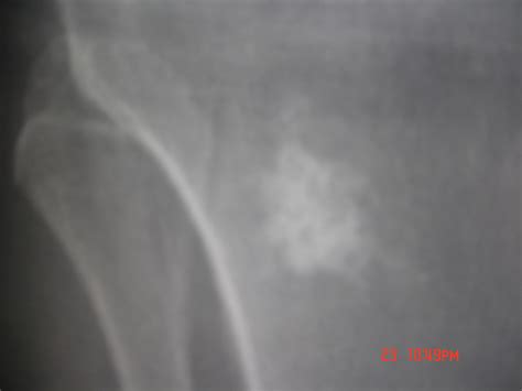 Msk Distal Femoral Cortical Defect Or Non Ossifying Fibroma And