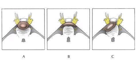 Transcochlear Approach Jackler Collection Volumes The Neurosurgical Atlas