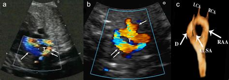 Prenatal Diagnosis And Outcome Of Isolated Vascular Rings American