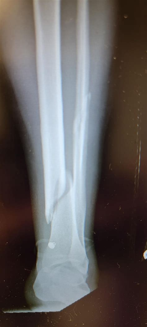 Broke My Tib Fib In July R Brokenbones