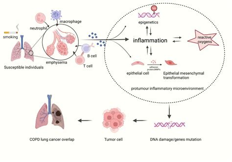 From Copd To Lung Cancer Copd