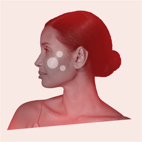 Hyperpigmentation On Back