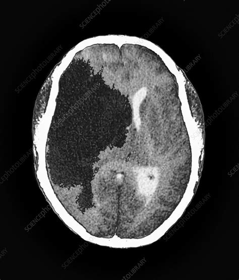 Stroke Ct Scan Stock Image C0152732 Science Photo Library