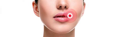 Reduce Swollen Lips Allergic Reaction
