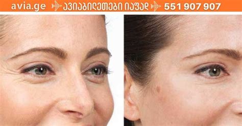 ძვირადღირებული საშუალებები აღარაა საჭირო აფთიაქში შეიძინთ ნაოჭების საწინააღმდეგო უამრავ