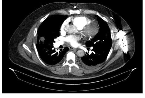 Transaxial View In Computed Tomography Imaging Demonstrating