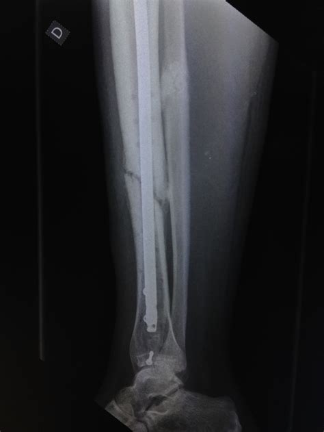 Management Of A Complex Tib Fib Fracture After Delayed Union Any Thoughts