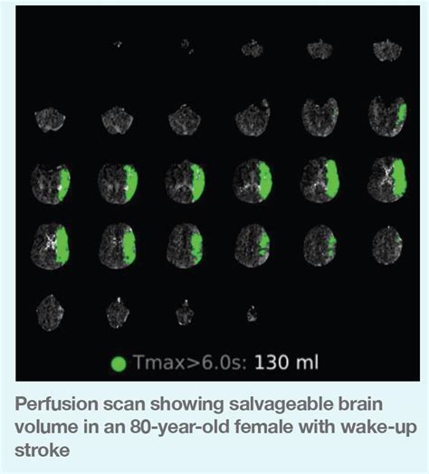 Advanced Imaging Can Identify Ischaemic Stroke Patients For Intra Arterial Thrombectomy 6 Hours