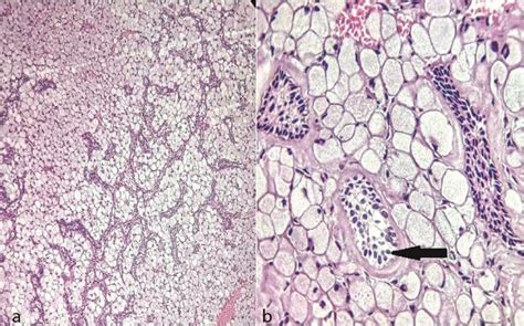 Histopathologic Sections Show A Sheets And Lobules Of Eosinophilic