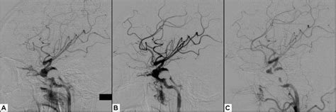 A Lateral View With Dsa After Transarterial Intra Aneurysmal Coil Download Scientific Diagram