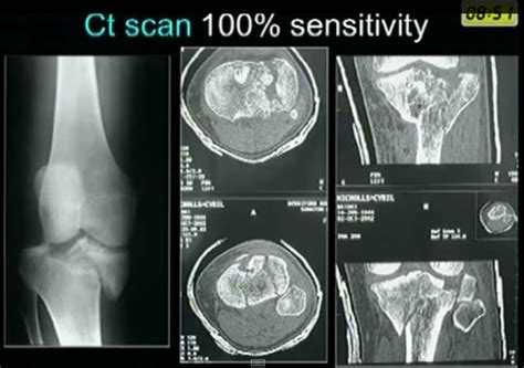 Proximal Tibia Fractures —