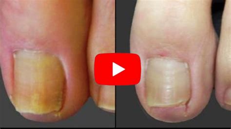 New Breakthrough The Hidden Cause Of Nail Fungus And How To Eliminate