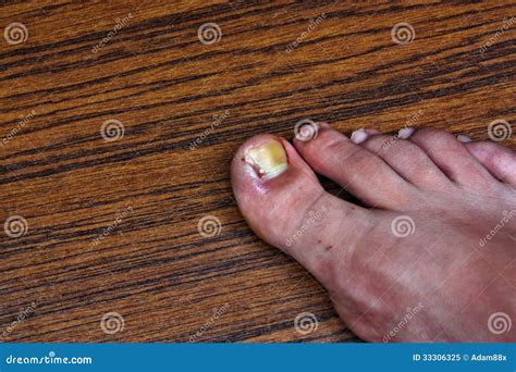 Swollen Ingrown Toe Stock Image Image Of Disgusting