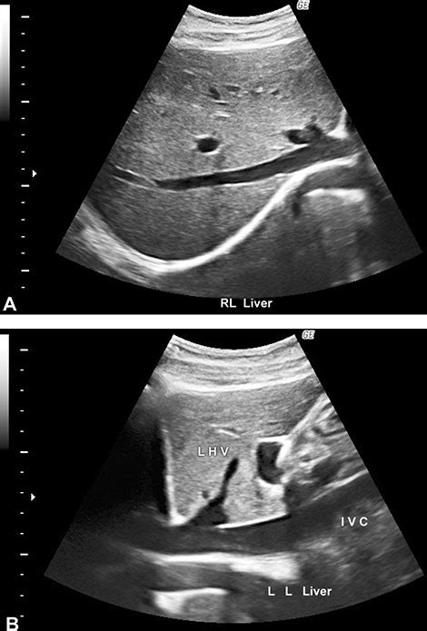 Caudate Lobe Of Liver Ultrasound