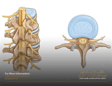 علاج تحرك فقرات العمود الفقري