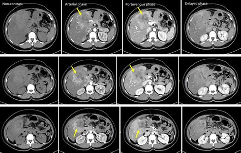 Mass Forming Intrahepatic Cholangiocarcinoma Radiology Cases
