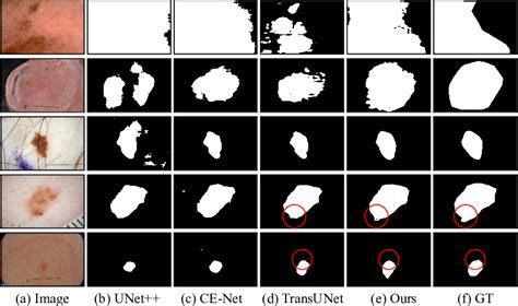Visual Comparison Of Lesion Segmentation Results Produced By Different Download Scientific
