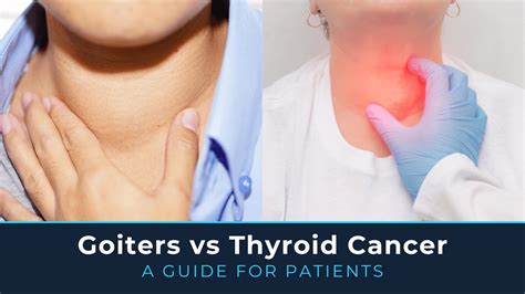 Goiters Vs Thyroid Cancer A Guide For Patients