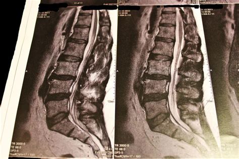 Mrt Lws Moderne Diagnosemoglichkeiten Im Detail Prospine Diagnostik