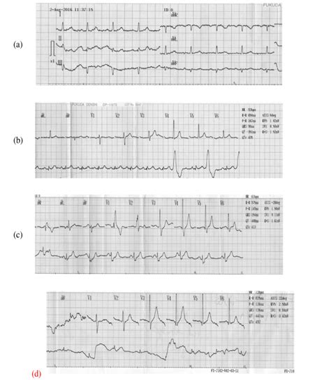 Examples Of Commonly Found ECG Changes In The Ni Exposed Workers A Download Scientific