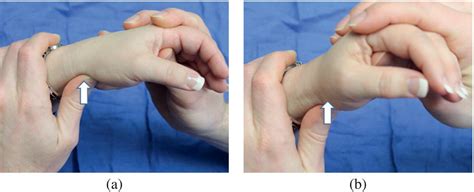 Occult Scaphoid Fractures Anesthesia Key