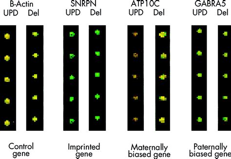 Microarray Analysis Of Genetranscript Expression In Prader Willi
