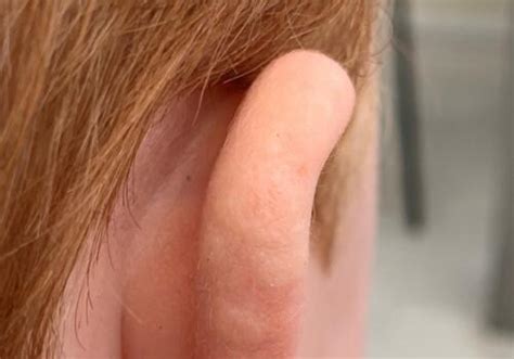 Polymorphic Light Eruption And Juvenile Spring Eruption