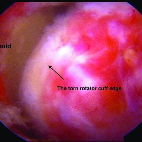 Illustration Of Arthroscopic Transosseous Superior Capsular