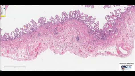 Gallbladder Chronic Cholecystitis Microscopy Talking Slide Youtube