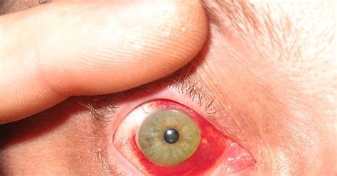 Why You Should Always Wear Safety Glasses Imgur