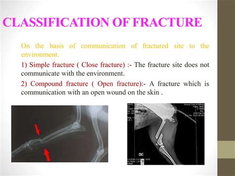 Vsr610pptfracturepptx Classification Of Fractures Pptx