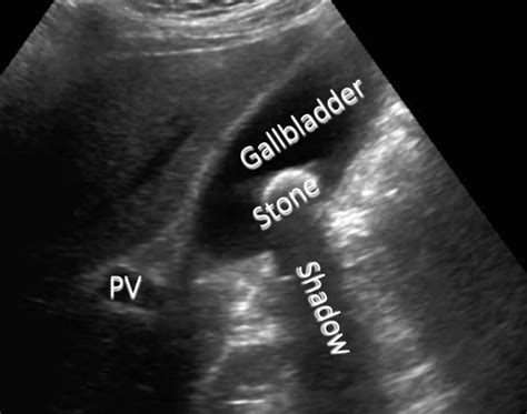 Gallbladder Ultrasound Gallstones