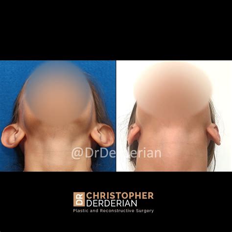 Otoplasty Surgery And Ear Pinning Near Me Dallas Texas Dr Derderian