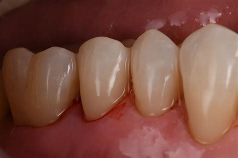 cervical augmentation non invasive composite restorations