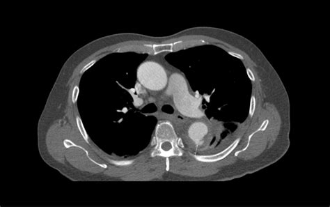 Ulcer Like Projection Ulpaxial Post Contrast Images Demonstrates Download Scientific