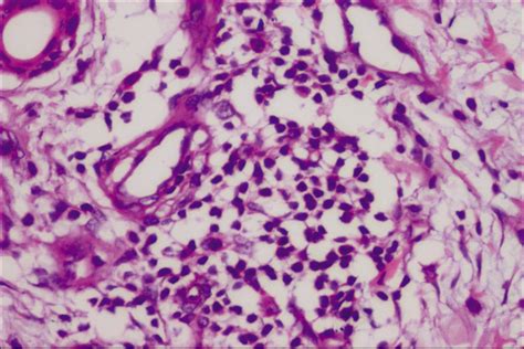 Atypical Clinical And Dermoscopic Features Of Hobnail Hemangioma