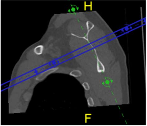 Pre Operative Radiographic Assessment Shoulder Arthroplasty Book