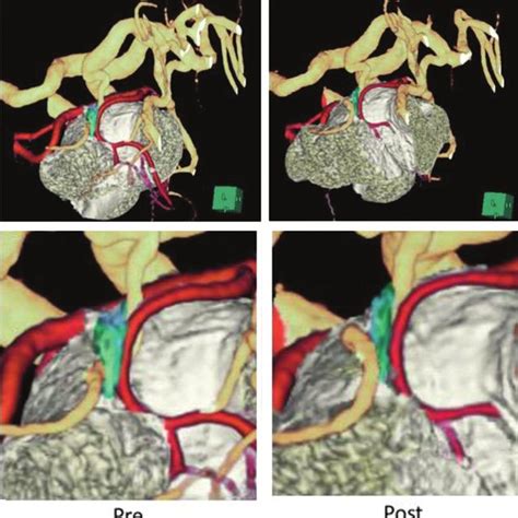 Pdf Trigeminal Neuralgia Caused By A Persistent Primitive Trigeminal Artery Variant And