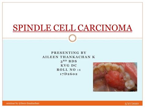 Spindle Cell Carcinoma Pptx Ear Nose And Throat Conditions