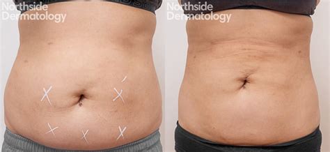 Trusculpt Id Melbourne Northside Dermatology