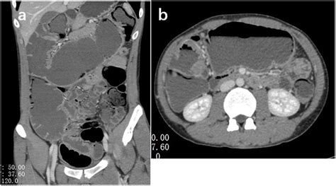 An Unusual Cause Of Intestinal Ulcers Masquerading As Inflammatory Bow Jir