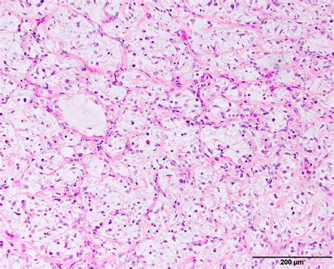 Liposarcoma Pathology Outlines