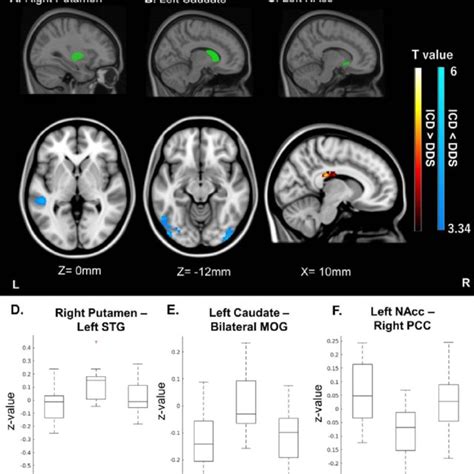 Seed Based Correlation Analysis Comparing The Functional Connectivity Download Scientific