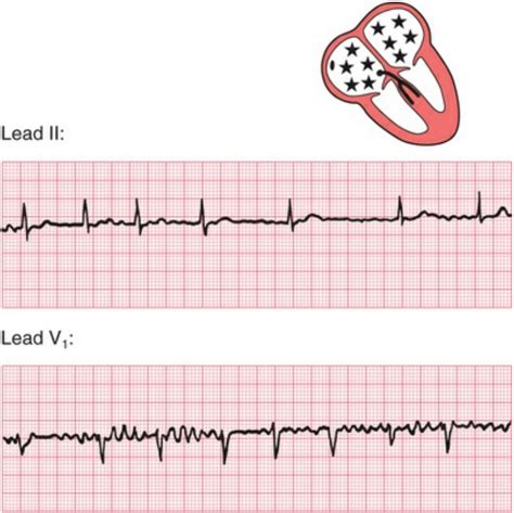 Cara Baca Ekg Keperawatan Kritis