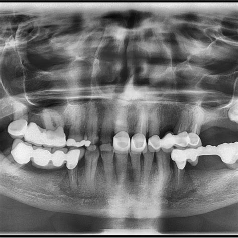 Pdf Lymph Node Abscess Caused By Francisella Tularensis A Rare
