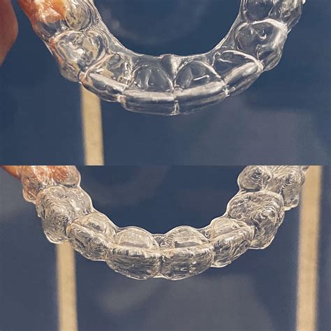 Retainer Different From Last Aligner R Invisalign